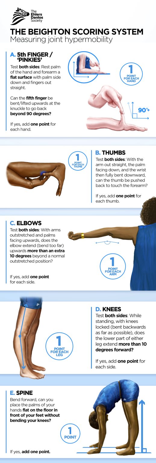 Assessing Joint Hypermobility - The Ehlers Danlos Society