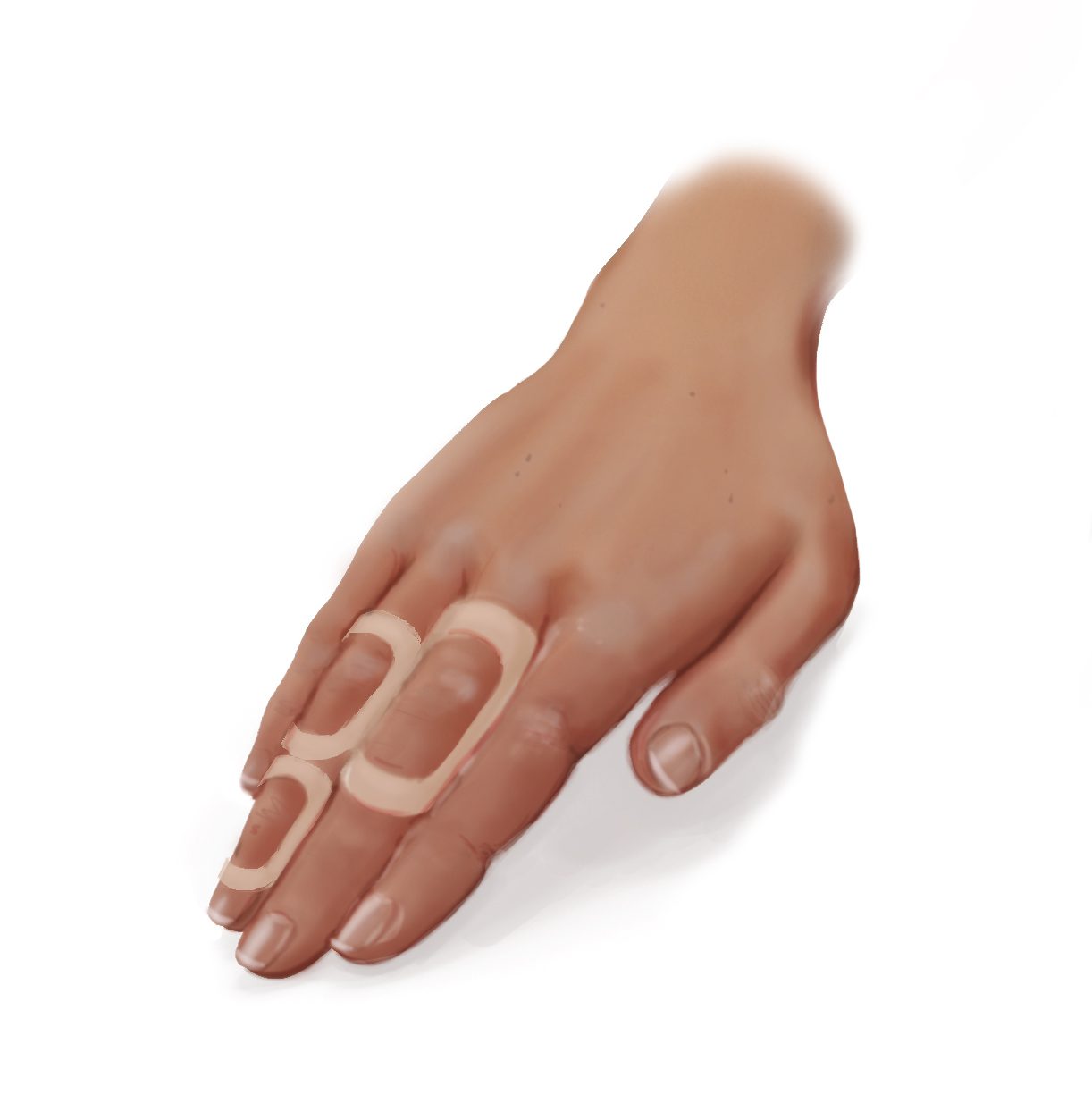 Ring splints for Ehlers-Danlos syndrome & hypermobility spectrum ...