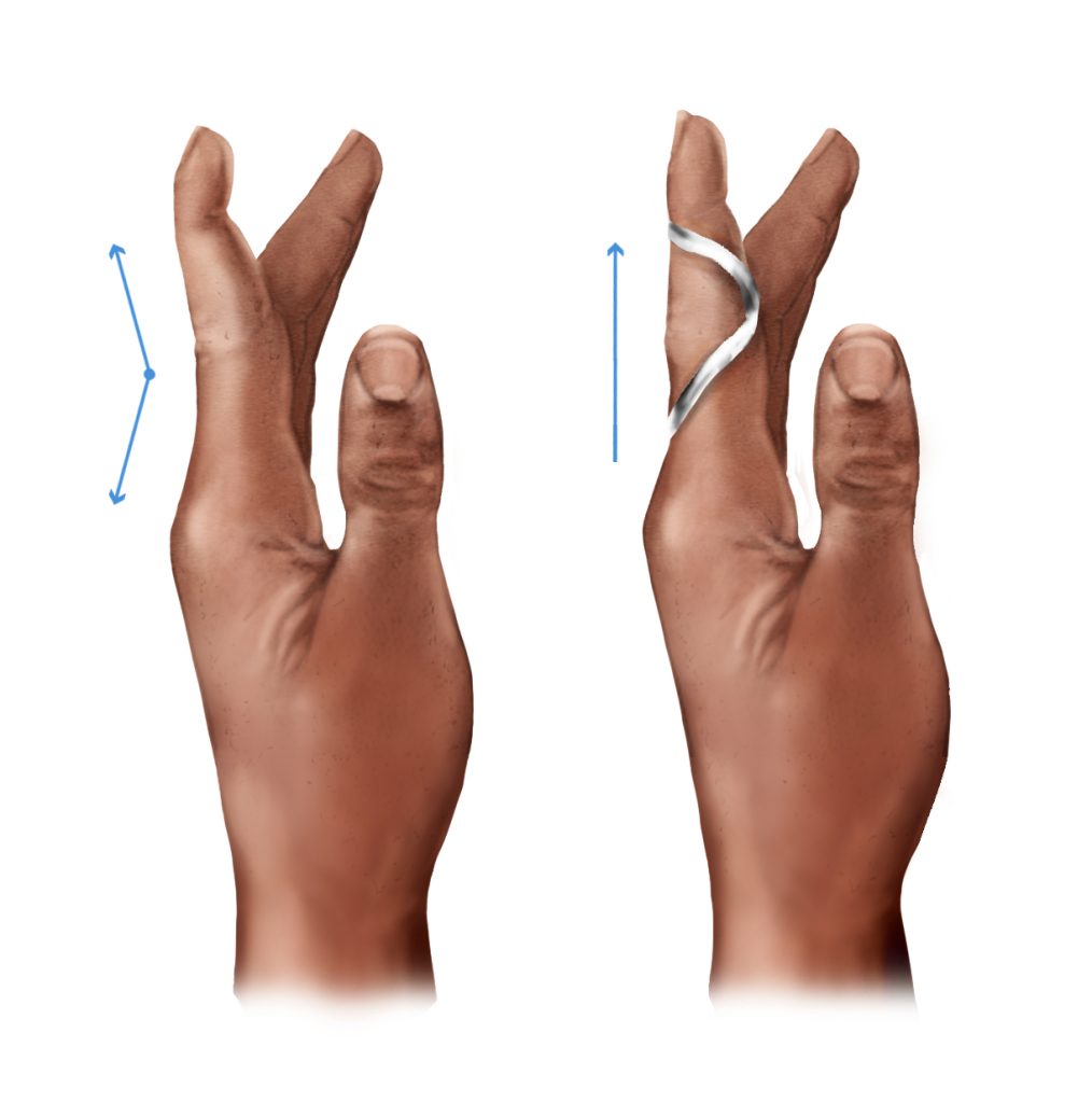 Ring splints for Ehlers-Danlos syndrome & hypermobility spectrum ...