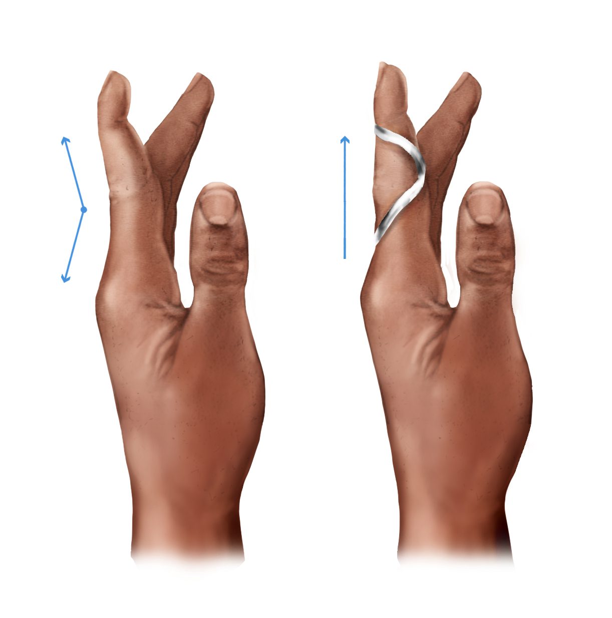 Ring splints for Ehlers-Danlos syndrome & hypermobility spectrum ...