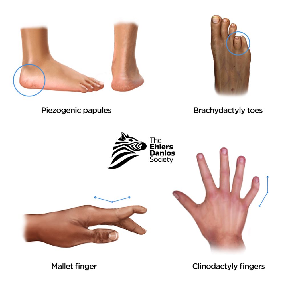 Classical Like Ehlers Danlos Syndrome Cleds The Ehlers Danlos Society
