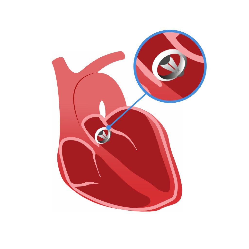 Cardiac-Valvular Ehlers-Danlos Syndrome (cvEDS) - The Ehlers Danlos Society
