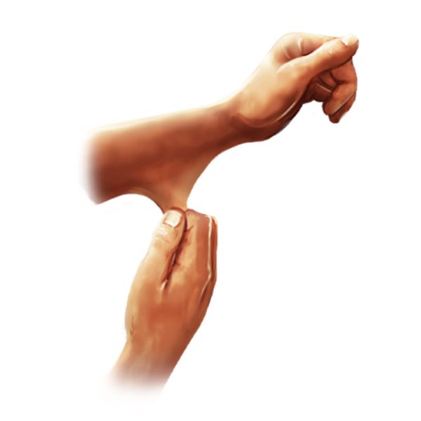 Skin Features of EDS - The Ehlers Danlos Society