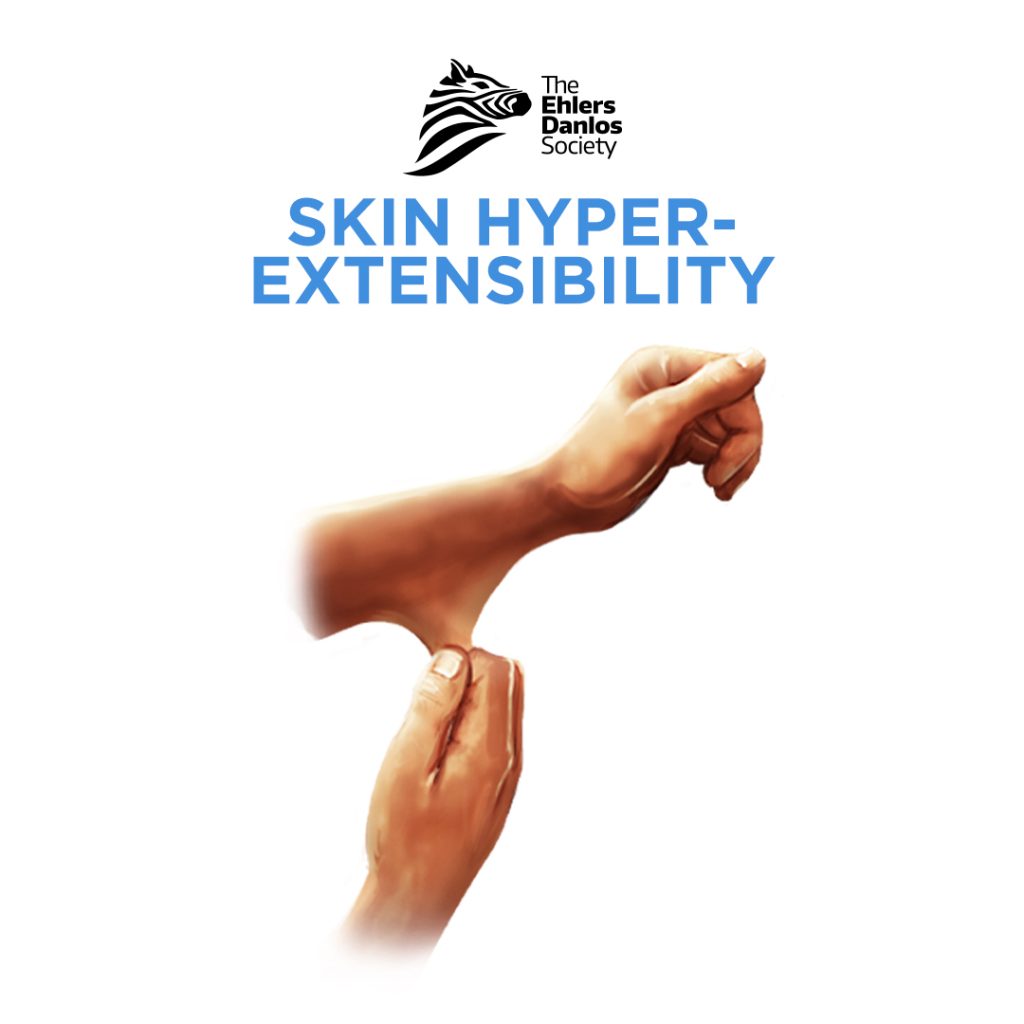 Classical-Like EDS (clEDS) - The Ehlers Danlos Society